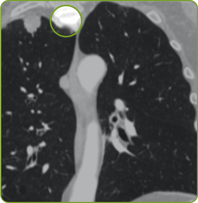 Optellum Lung Nodules